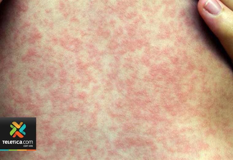 Sarampión, la enfermedad más contagiosa, resurge con el descuido de las ...