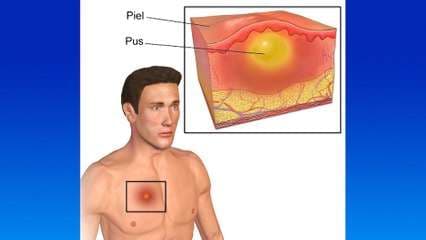 ¿Por qué se forman los diviesos? | Teletica
