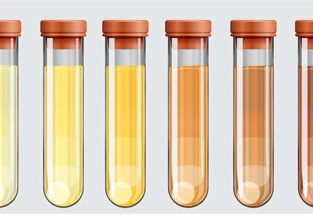 Qué significa el color de tu orina y cuándo debes preocuparte | Teletica